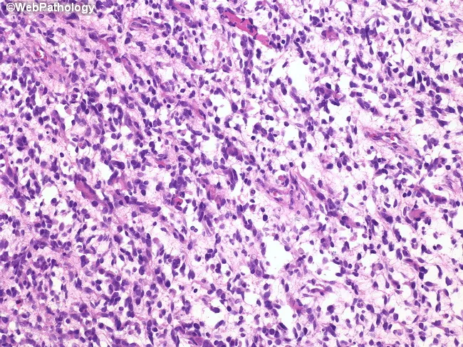 Embryonal Rhabdomyosarcoma