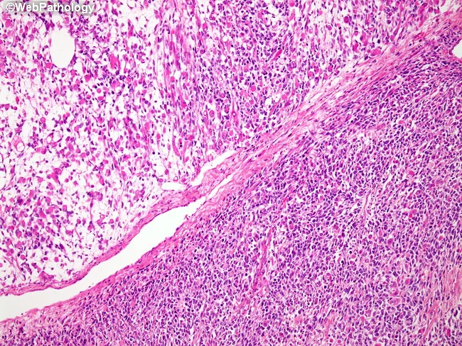 Embryonal Rhabdomyosarcoma