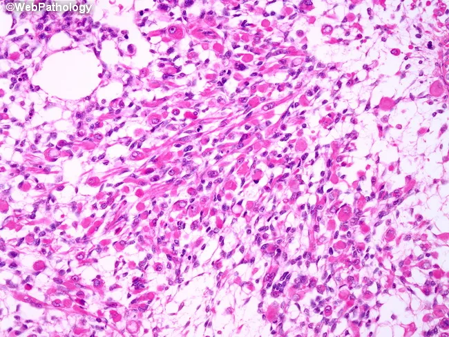 Embryonal Rhabdomyosarcoma