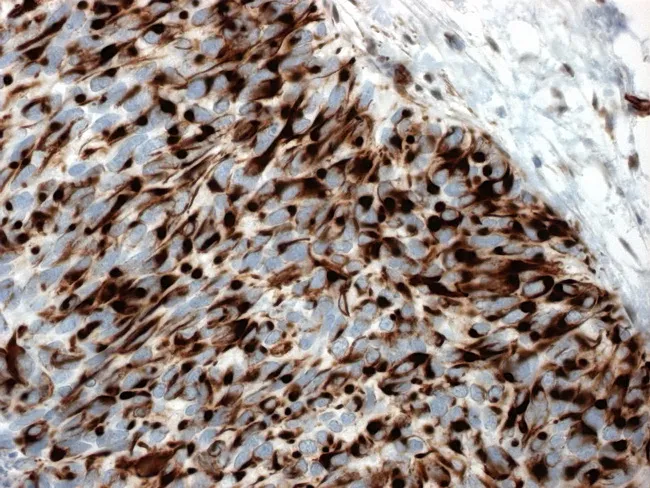 Desmoplastic Small Round Cell Tumor : WT1