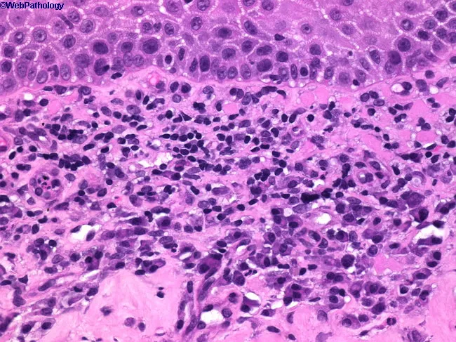 Plasma Cell Balanitis