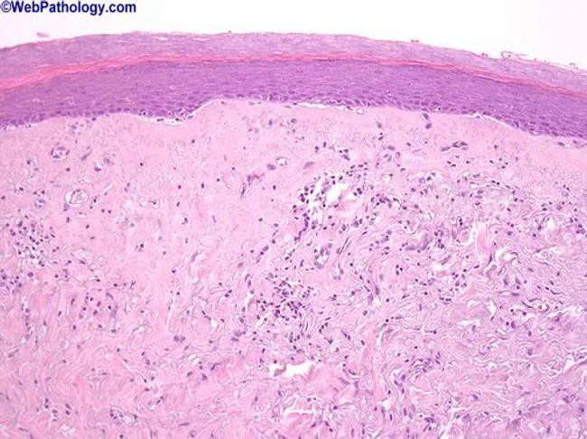 Balanitis Xerotica Obliterans , Symptoms, diagnosis and treatment – MIDF