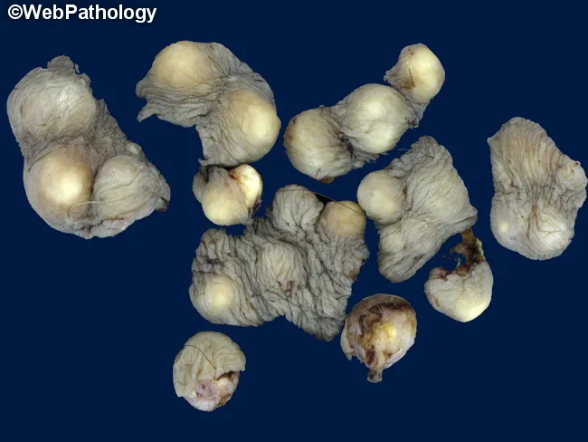 Idiopathic Scrotal Calcinosis
