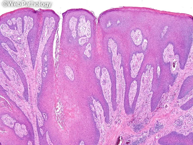 verruciform xanthoma