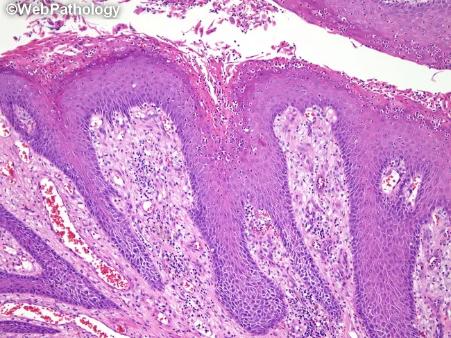 verruciform xanthoma