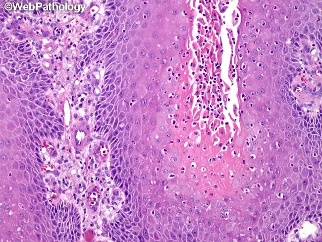 Verruciform Xanthoma