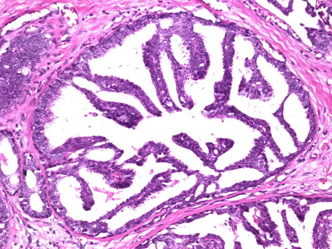 Ductal Carcinoma-in-situ : Micropapillary
