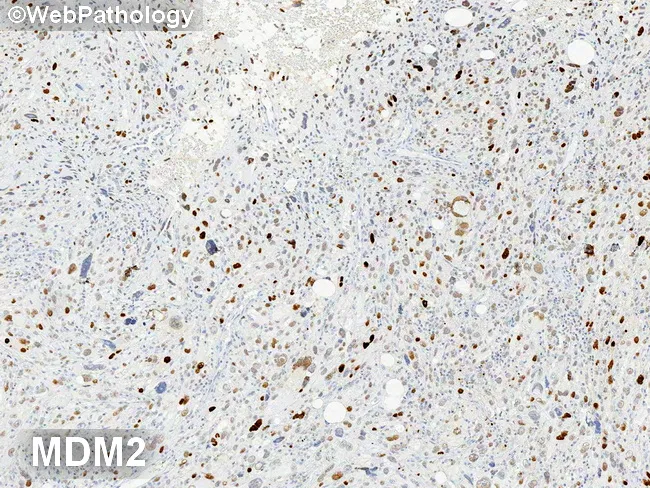 Dedifferentiated Liposarcoma : MDM2 Amplification