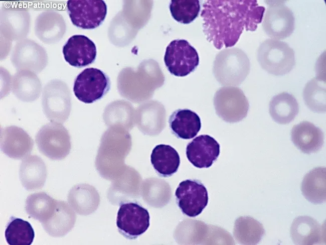 CLL : Introduction & Clinical