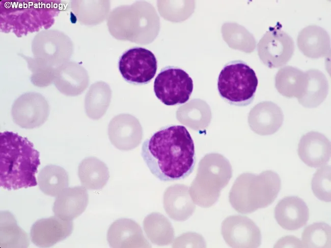 Chronic Lymphocytic Leukemia Smudge Cells
