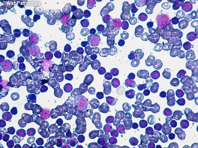 Monoclonal B-Lymphocytosis