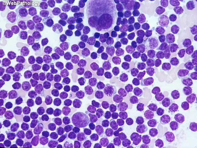 CLL in Bone Marrow