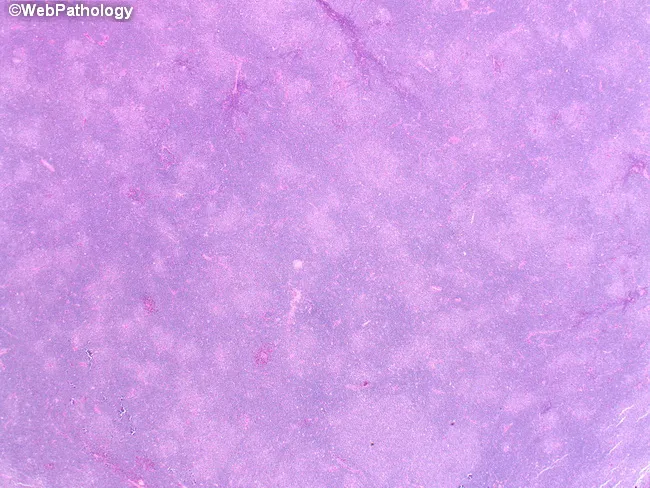 SLL in Lymph Node