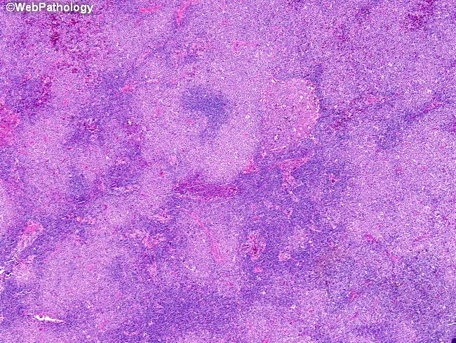SLL in Lymph Node