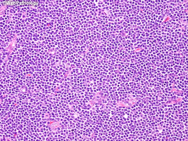 SLL in Lymph Node