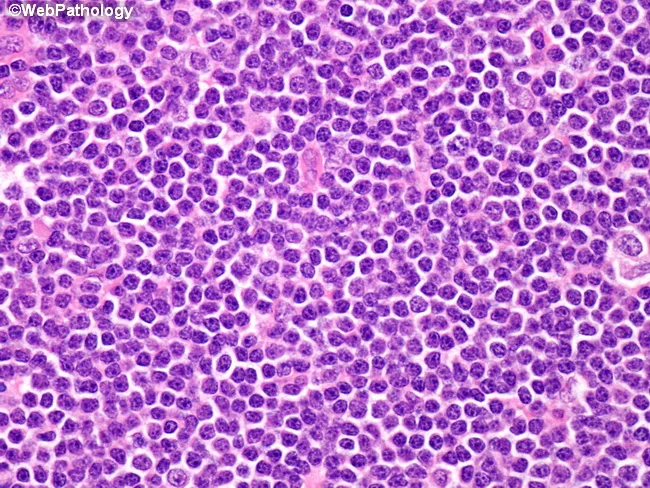 SLL in Lymph Node : Immunophenotype