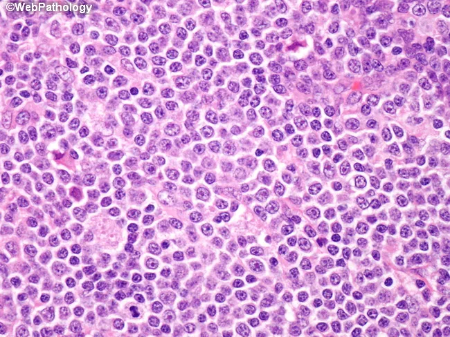 SLL in Lymph Node