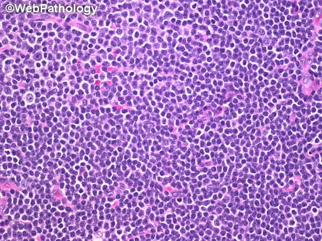 SLL in Lymph Node
