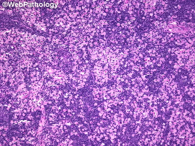SLL in Lymph Node : Signet Ring Cell Pattern