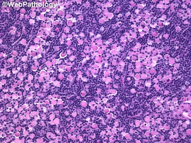 SLL in Lymph Node : Signet Ring Cell Pattern
