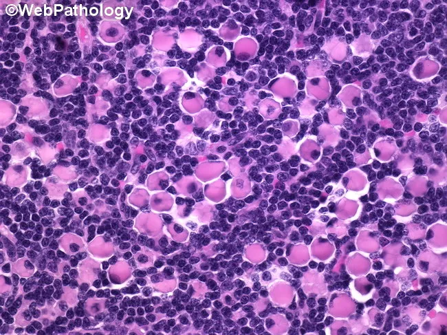 SLL in Lymph Node : Signet Ring Cell Pattern