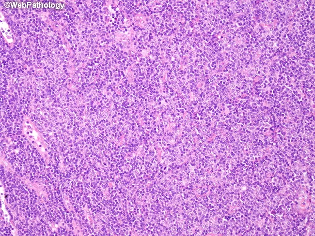 CLL/SLL with Hodgkin Lymphoma