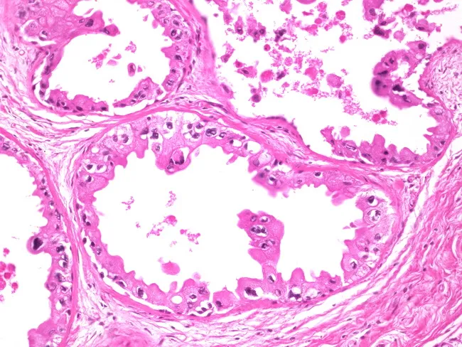Ductal Carcinoma-in-situ : Apocrine