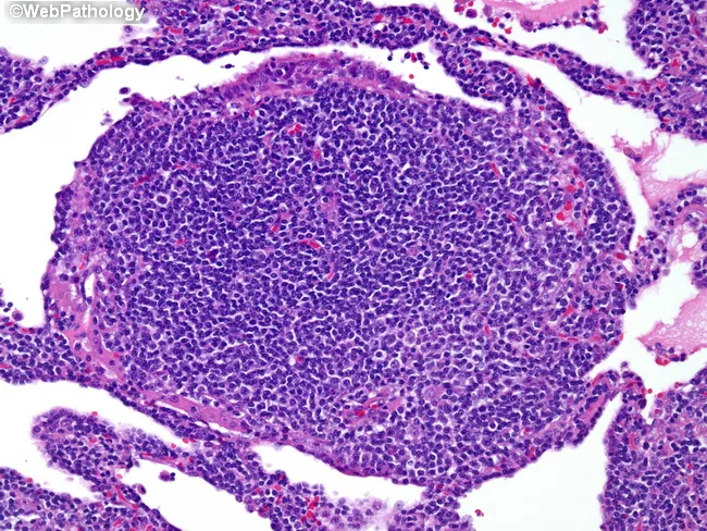 CLL/SLL in Lungs