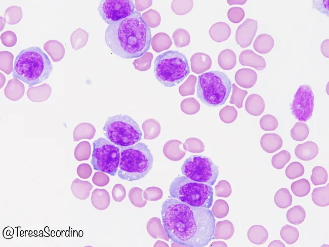 B-cell Prolymphocytic Leukemia : Introduction