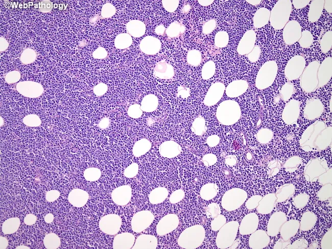 B-cell Prolymphocytic Leukemia : Clinical
