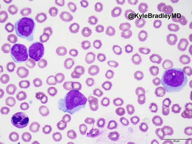 B-cell Prolymphocytic Leukemia : Microscopic