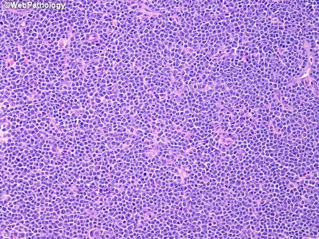 B-cell Prolymphocytic Leukemia : Microscopic