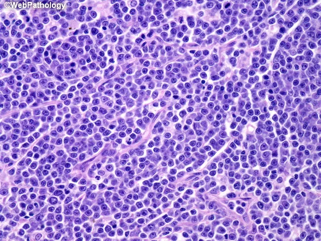 B-cell Prolymphocytic Leukemia : Differential