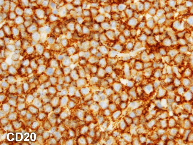 B-cell Prolymphocytic Leukemia : CD20