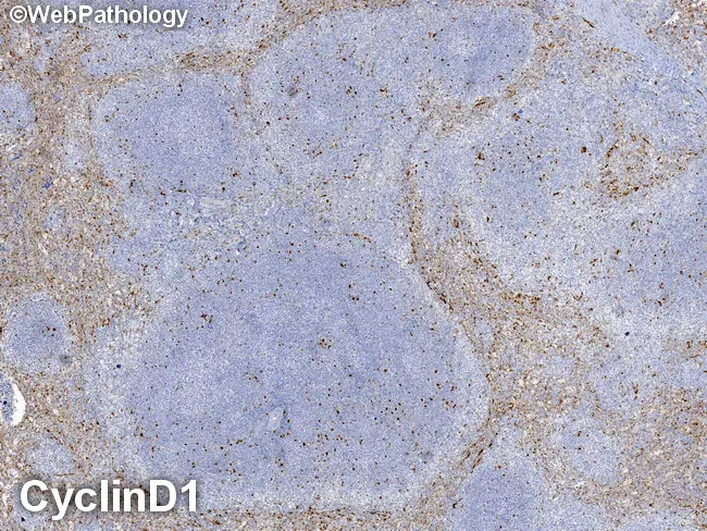 SMZL - Immunophenotype : CyclinD1