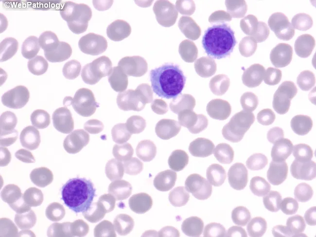 Hairy Cell Leukemia : Peripheral Blood