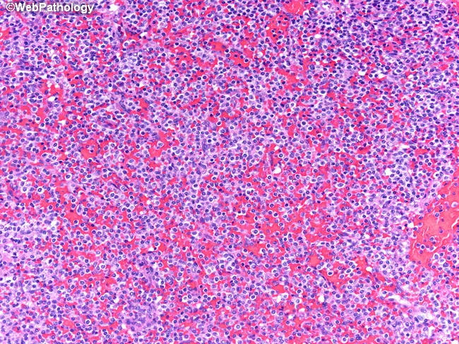 Hairy Cell Leukemia : Spleen
