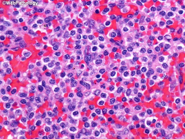 Hairy Cell Leukemia : Spleen