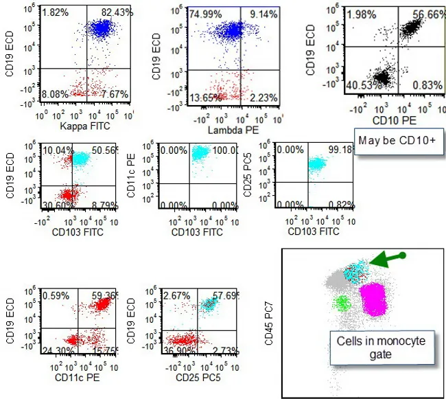 Hairy Cell Leukemia : Flow Cytometry
