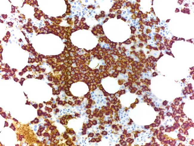 Hairy Cell Leukemia : CD20 in Bone Marrow Biopsy