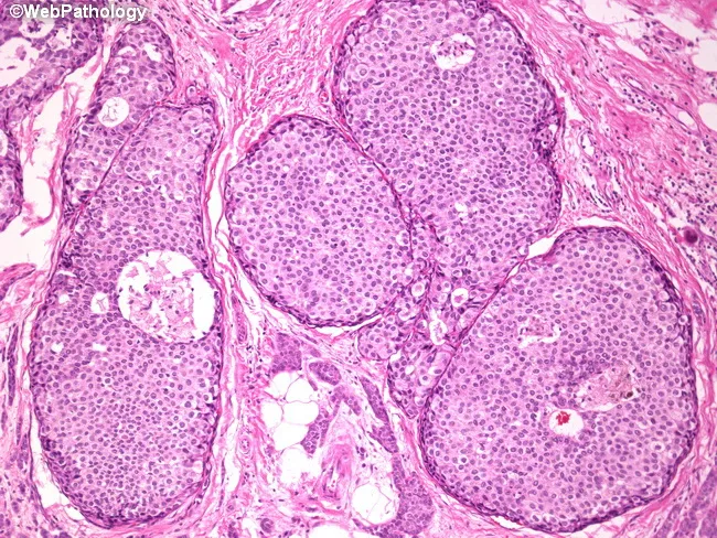 Lobular Carcinoma-In-Situ
