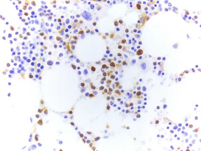 Hairy Cell Leukemia : TRAP Stain