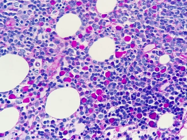 Lymphoplasmacytic Lymphoma : Dutcher Bodies