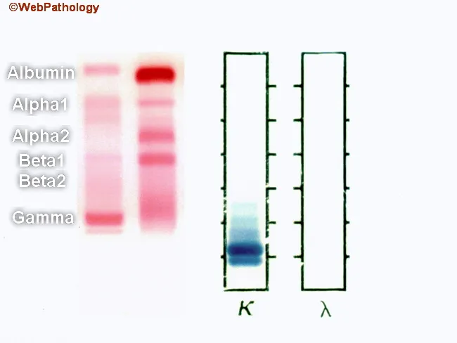 Myeloma : M Component