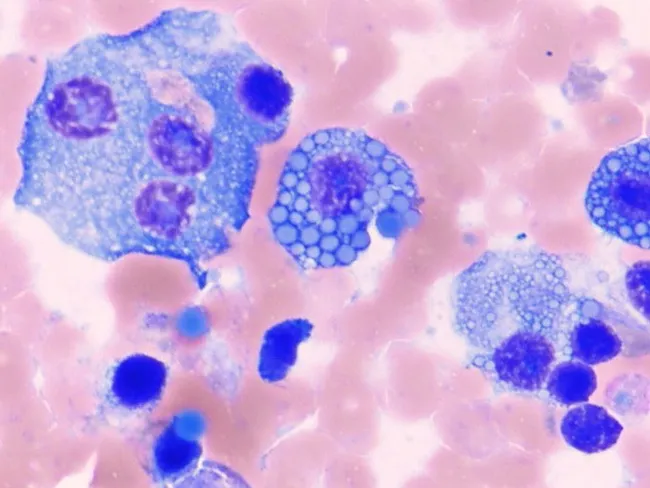 Myeloma : Russell Bodies / Mott Cell