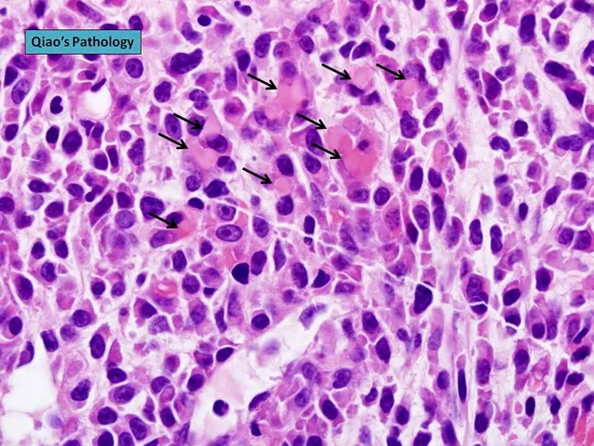 Myeloma : Russell Bodies