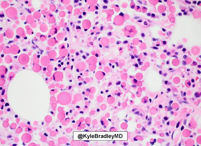 Myeloma : Russell Bodies