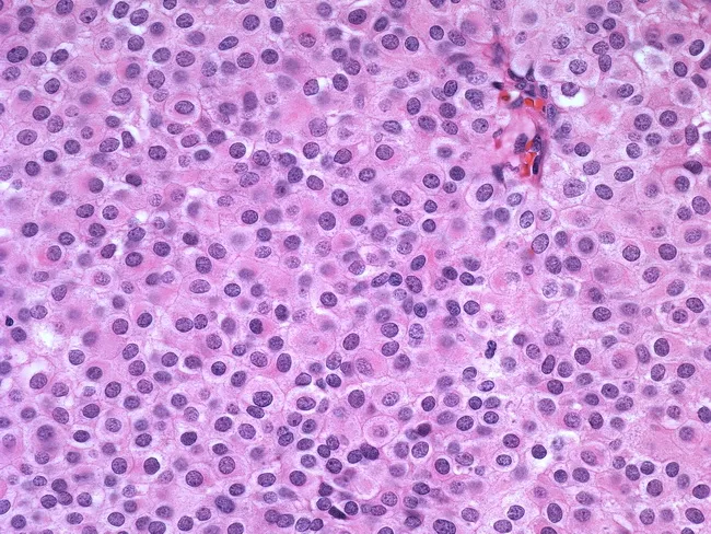 Lobular Carcinoma-In-Situ