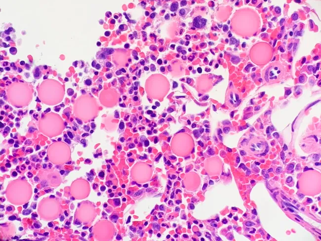 Myeloma : Russell Bodies