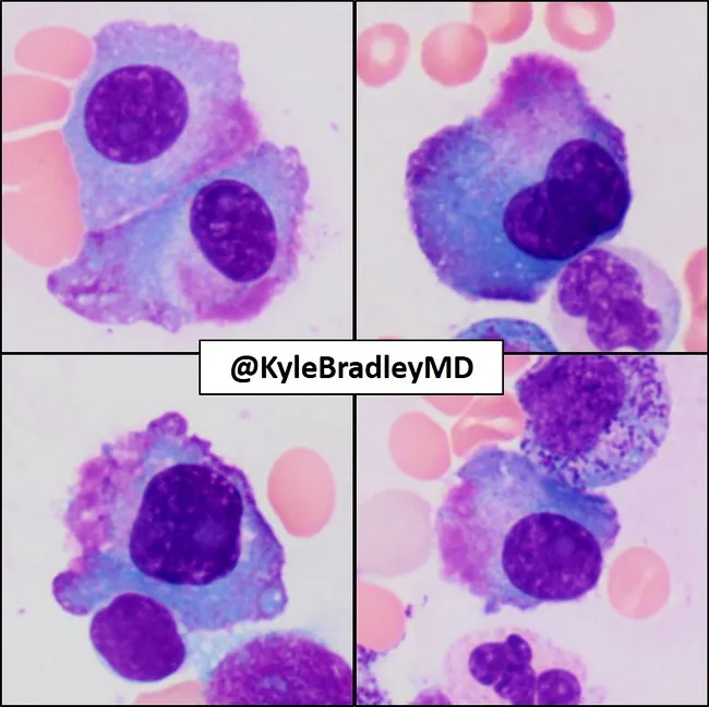 IgA Myeloma : Flame Cells